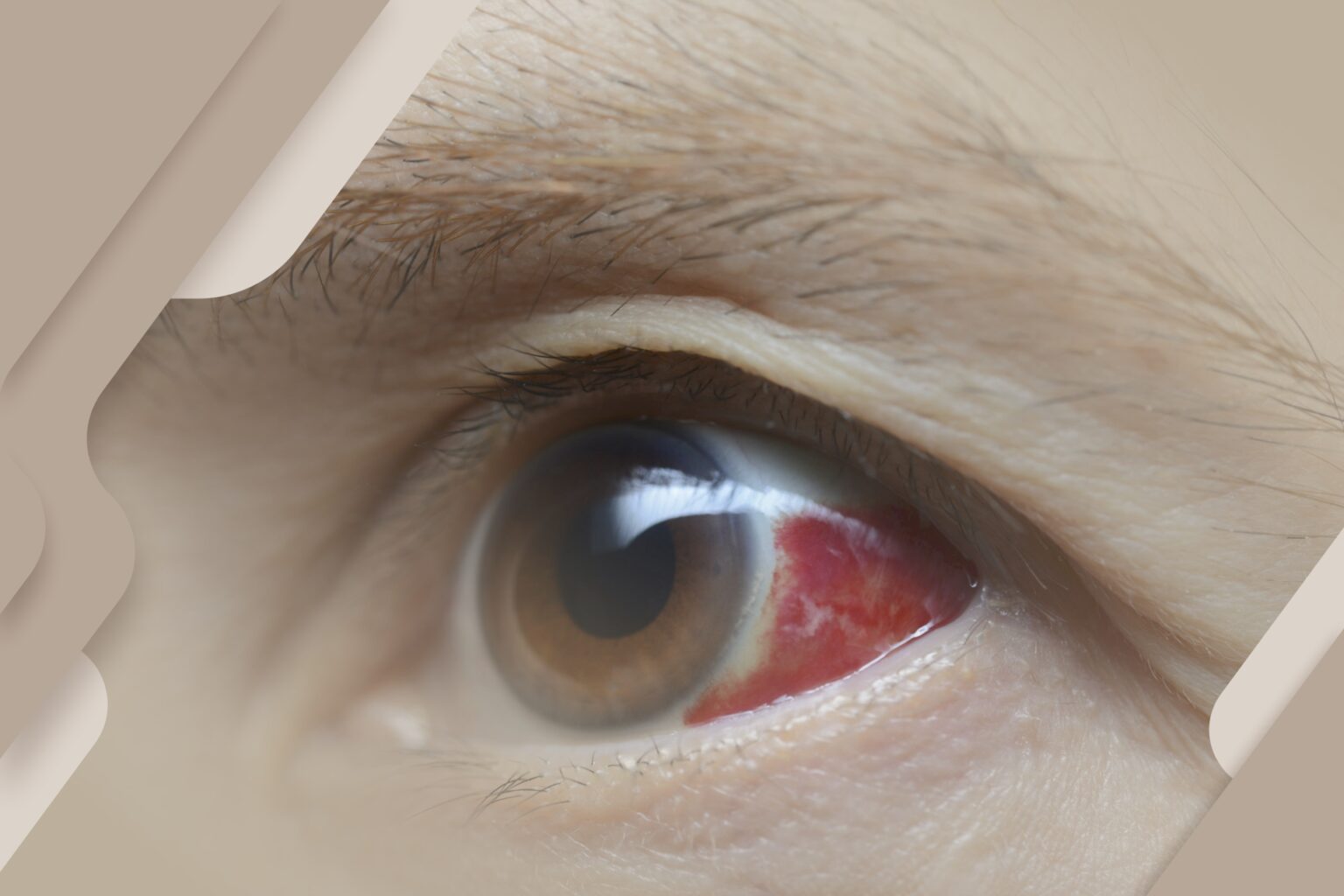 Derrame ocular - Oftalmocasa