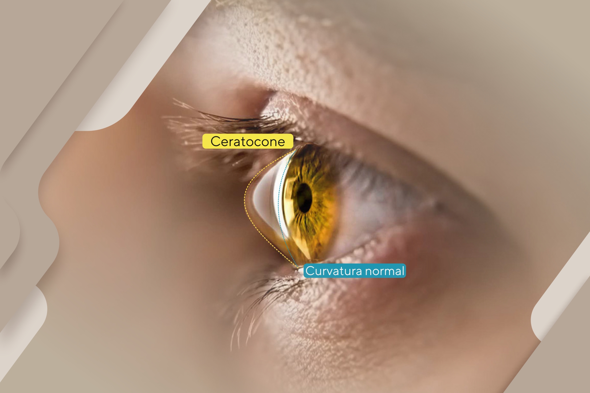O ceratocone - Oftalmocasa