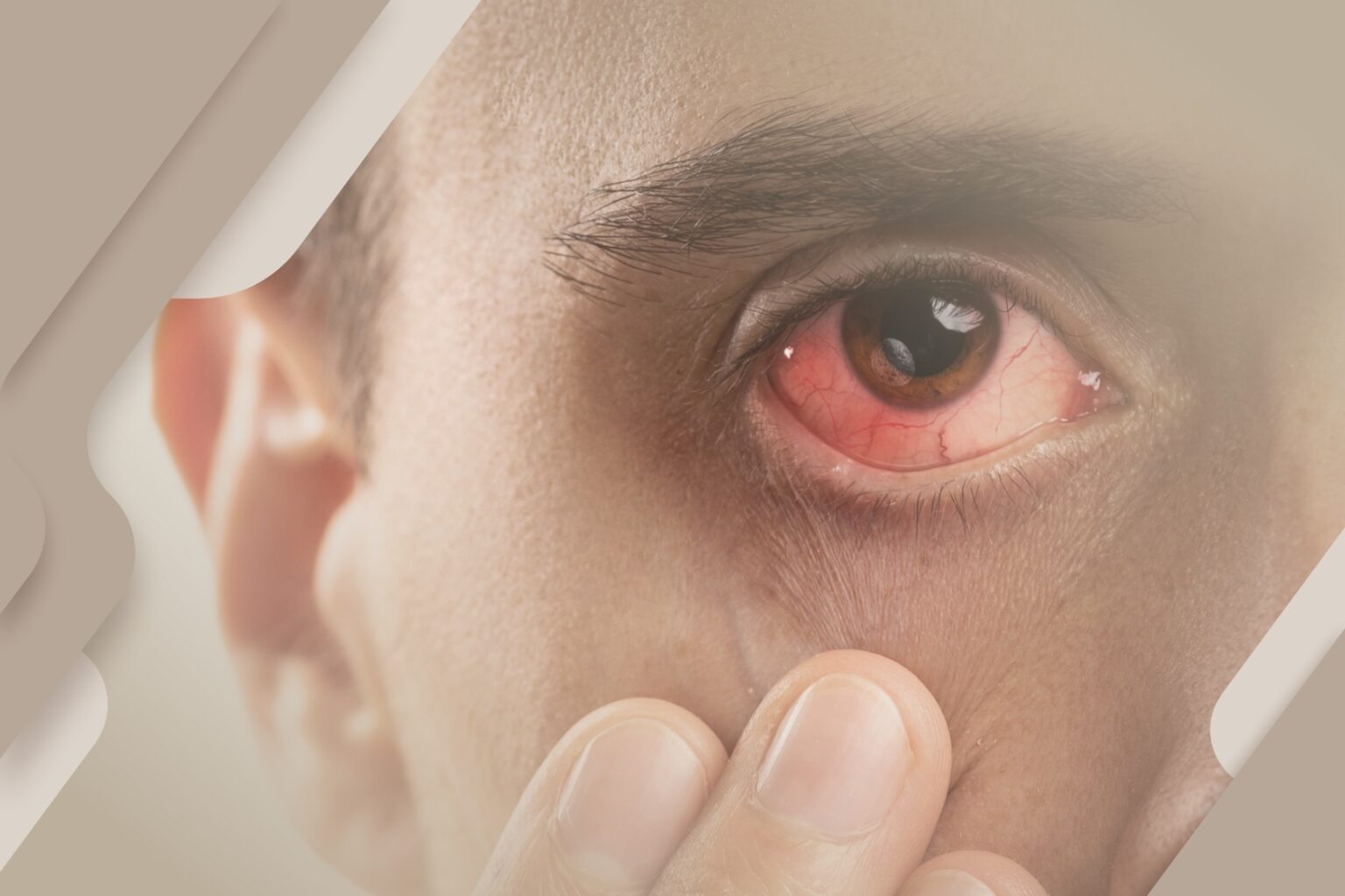 Inflamações e infecções mais comuns aos olhos - Oftalmocasa