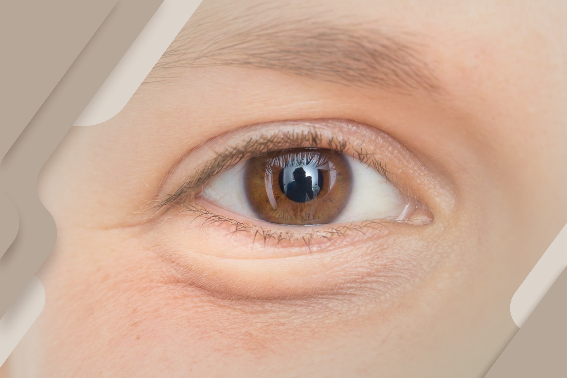 Quais as principais causas do olho inchado? - Oftalmocasa