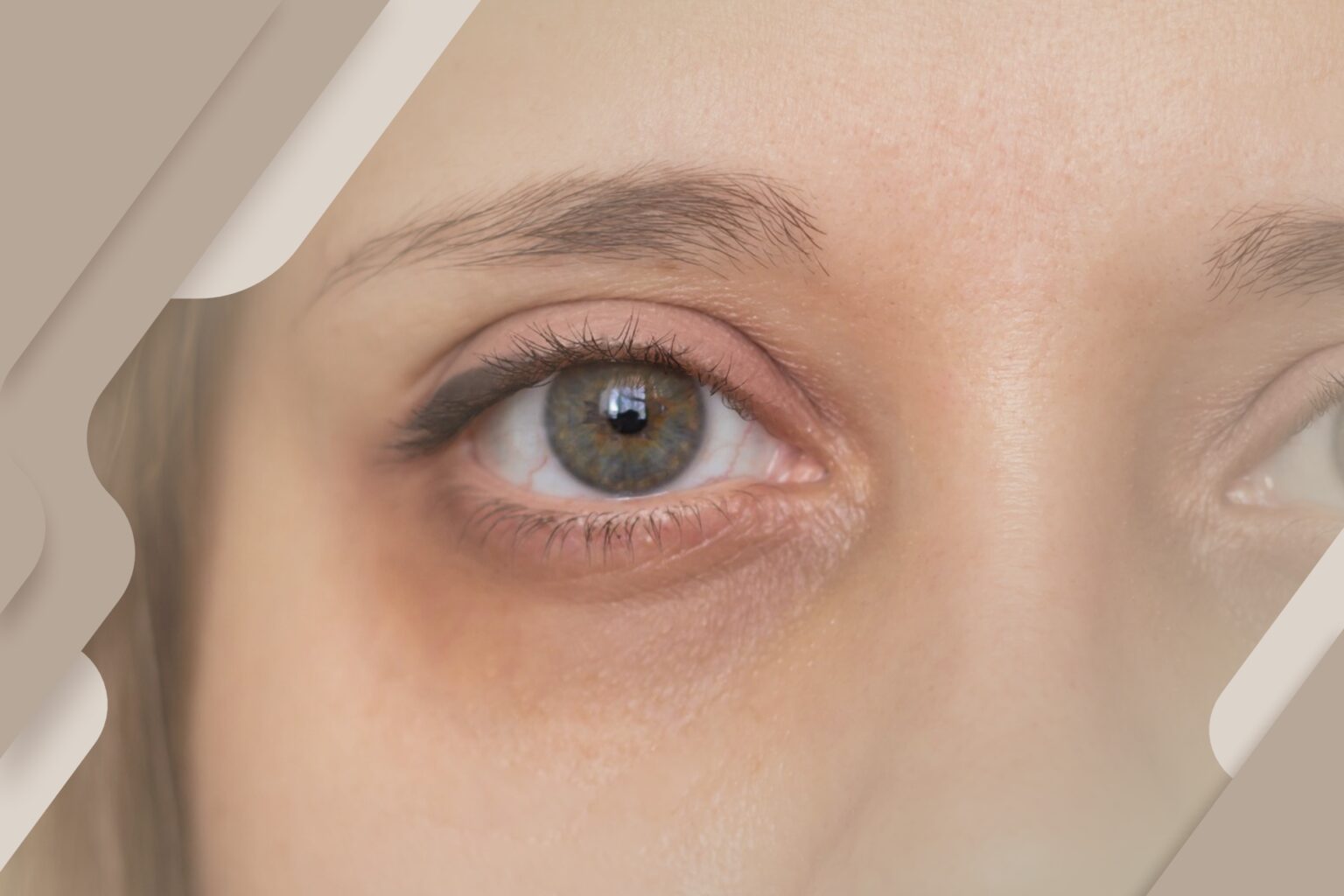 Olheiras Quais São As Causas Os Tipos E Como Combatê Las Oftalmocasa