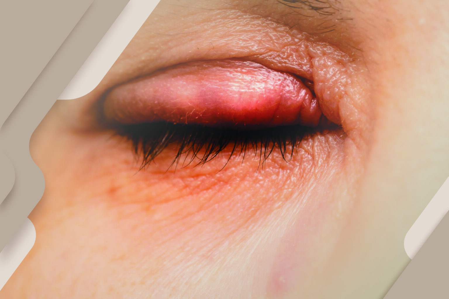 Conheça as principais causas de inchaço no olho. Veja quando é grave e ...